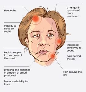 Facial Palsy | Sydney Centre ENT